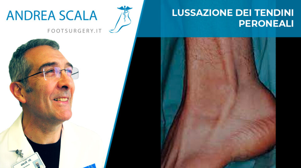 LUSSAZIONE DEI TENDINI PERONEALI - Dott. Andrea Scala
